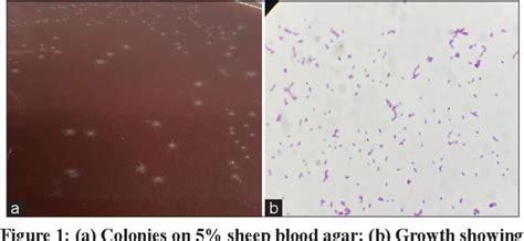 [pdf] Streptococcus Bovis Complex Isolated From Pleural Fluid In A Case Of Liver Cirrhosis An
