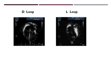 Segmental Analysis Of Cardiac Defects Ppt Pptx Heart And