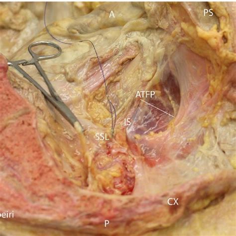 Cadaveric Left Hemipelvis With An Intact Anchor In The Sacrospinous Download Scientific Diagram