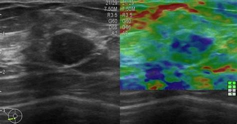 Breast And Axilla 54 Elastography Case 541 Elastography Benign