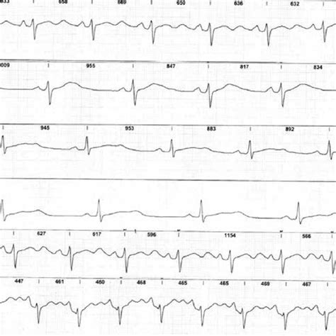 24 Hour Holter Ecg Monitoring Trace Different Period Of The Day The