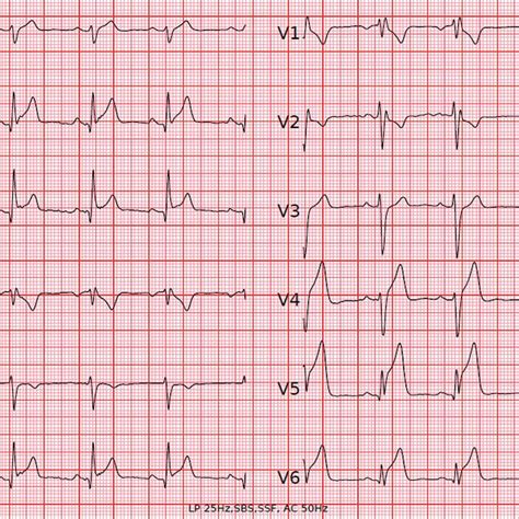 Patient 1 Initial 12 Lead Ecg Showing Sinus Rhythm At 66 Bpm With An