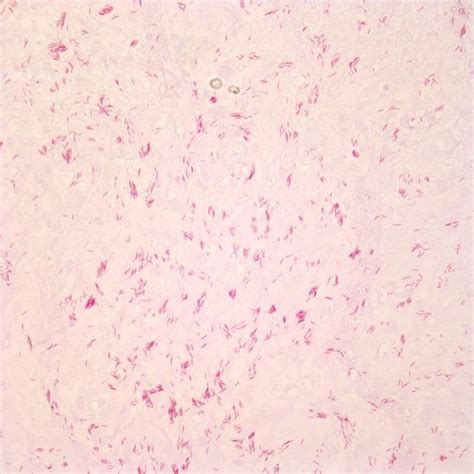 Numerous Acid Fast Bacilli Fite Stain Original Magnification X400