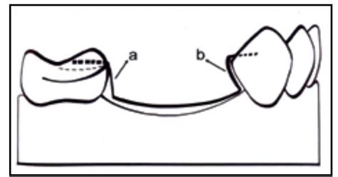 B Rpd Rotated In Position No Anterior Clasp A Minor