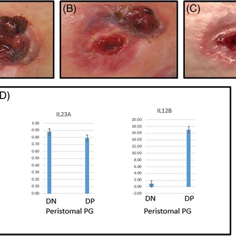 Pyoderma Gangrenosum In Ulcerative Colitis Download Scientific Diagram