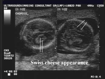 Choroid Plexus Ultrasound