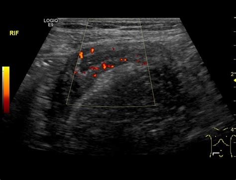 Basics Techniques Needed To Evaluate The Appendix Integrated Ultrasound Education