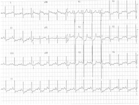 Electrocardiogram Shows Sinus Tachycardia Enlarged Right Atrium With