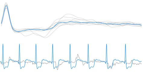Ecg Noise Removal Using Segmented Beat Modulation Arturo Moncada Torres — Biomedical Engineer