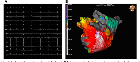 Figure 1 From Identifying The Origin Of Atrial Tachycardia In The Epicardial Region By Analyzing
