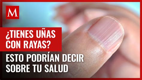 Esto Dicen De Tu Salud Las Uñas Con Rayas Grupo Milenio