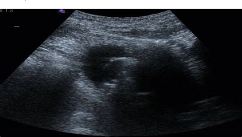 Pdf Suprapubic Catheter Insertion Using An Ultrasound Guided