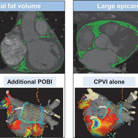 Measurement Of Epicardial Adipose Tissue Volume Using 3 Dimensional Download Scientific Diagram