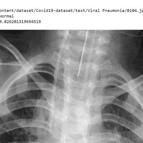 An Example Of The X Ray Classification Of A Healthy Person Download Scientific Diagram