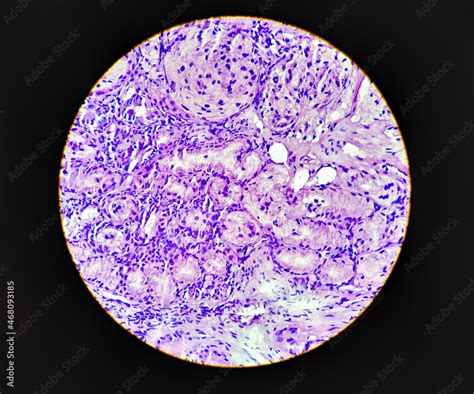 Photo Of Squamous Hyperplasia From Oral Mucosa Sample Magnification 200x Photo Under