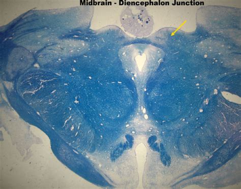 Midbrain Diencephalon Junction Diencephalon 1 Flashcards Quizlet