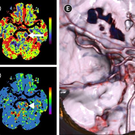 Brain Computed Tomography CT And CT Angiography Were Performed Download Scientific Diagram