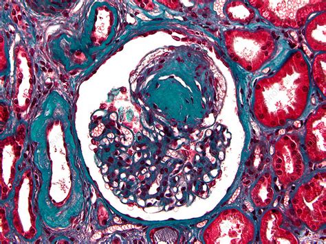 Glomerulosclerosis In Diabetes Light Micrograph Stock Image C032 0461 Science Photo Library