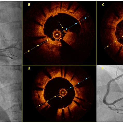 A Sixty Year Old Patient Was Referred For Primary Pci Due To Inferior