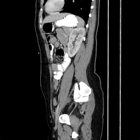 Filecrohns Disease Terminal Ileitis Fistulizing Radiopaedia 98245