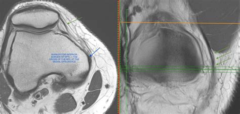 Torn Medial Retinaculum Knee Medial Patellofemoral Ligament