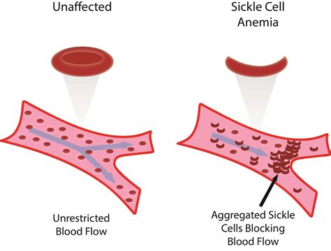 Type Of Mutation That Causes Sickle Cell Anemia At Elizabeth Baldree Blog