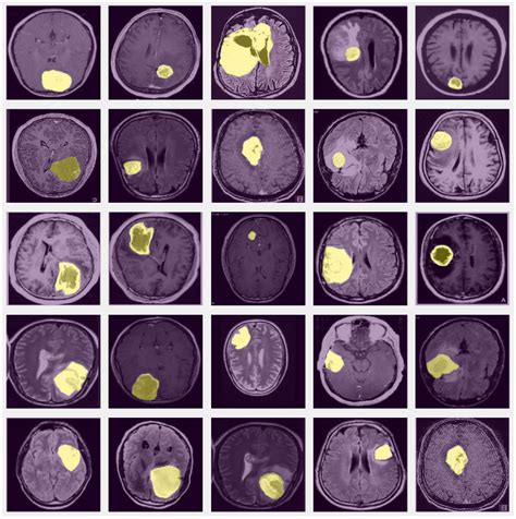 GitHub Heba Atef Multi Cancer Identification And Segmentation This Is A Project For Brain