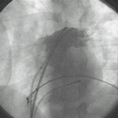 A Pulmonary Venogram Is Shown In A Patient Undergoing An Ostial