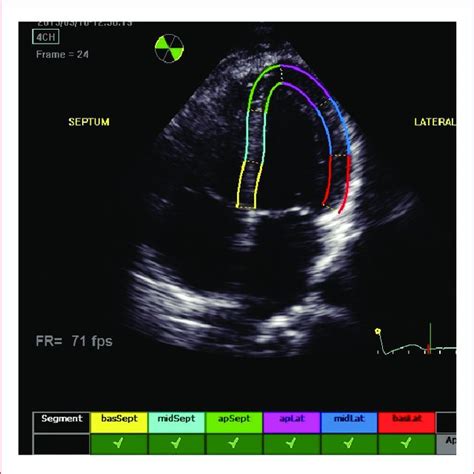 Echocardiograph Shows Segmental Analysis Of The Left Ventricle After 2d Download Scientific