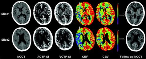 Identification Of Infarct Core And Penumbra In Acute Stroke Using Ct Perfusion Source Images Pmc