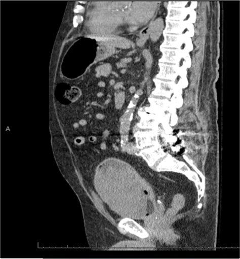 Ct Urogram Sagittal View Demonstrating Large Intravesical Tumor Download Scientific Diagram