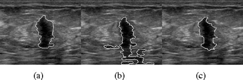 Figure 1 From A Saliency Model For Automated Tumor Detection In Breast Ultrasound Images