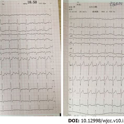 Preoperative And Postoperative Electrocardiograms Download Scientific Diagram