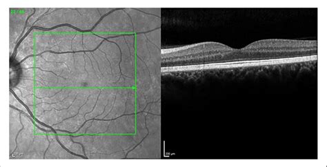 Oct Macular Of The Left Eye Download Scientific Diagram