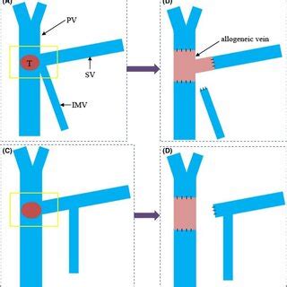 The Change Of Splenic Volume Before And Months After Operation On Download Scientific Diagram