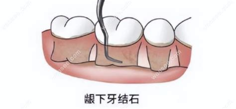 来看龈下洁治和龈下刮治的区别 为啥牙龈刮治做了后悔死了 口腔资讯 牙齿矫正网