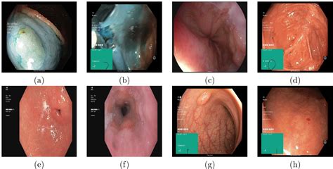 논문 리뷰 Enhanced Multi Class Classification Of Gastrointestinal Endoscopic Images With