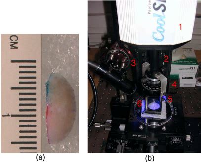 Photograph Of A Sample With Nonmelanoma Skin Cancer Nodular BCC Download High