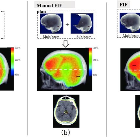 Dose Distributions Of The Original Manual Field In Field Fif And