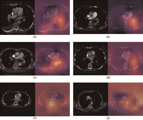 Class Activation Maps Class Activation Map Cam Representation Of