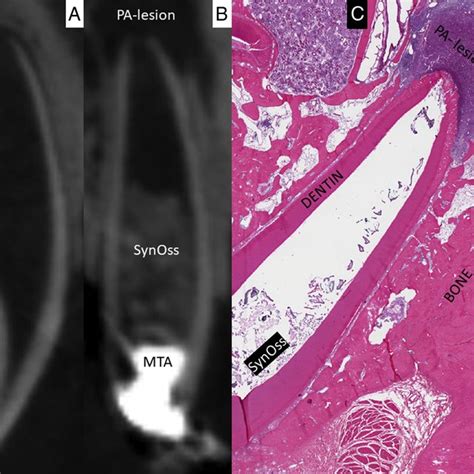 A The Preoperative Cbct Sagittal Section Of A Maxillary Cuspid With Download Scientific