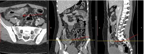 A Coronal Slice Of Computed Tomography Ct Image Of Small Bowel