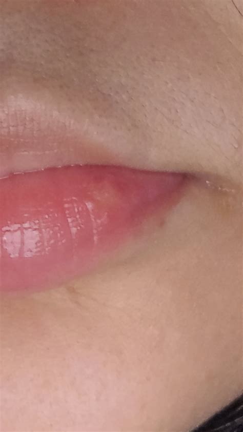Canker Sore Or Cold Sore Rcankersores