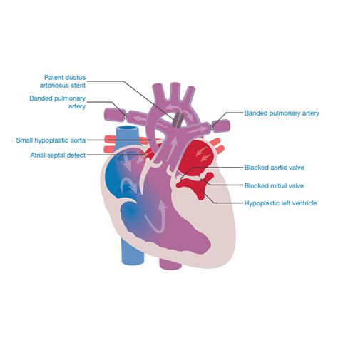 Norwood Procedure