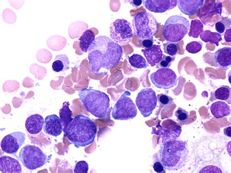 Acute Myeloid Leukemia With Multilineage Dysplasia 1