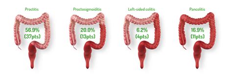 Ulcerative Proctitis Ferring Healthcare Professional