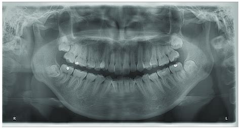 Opg Showing The Darkening Of The Root Of A Right Lower Third Molar Download Scientific Diagram