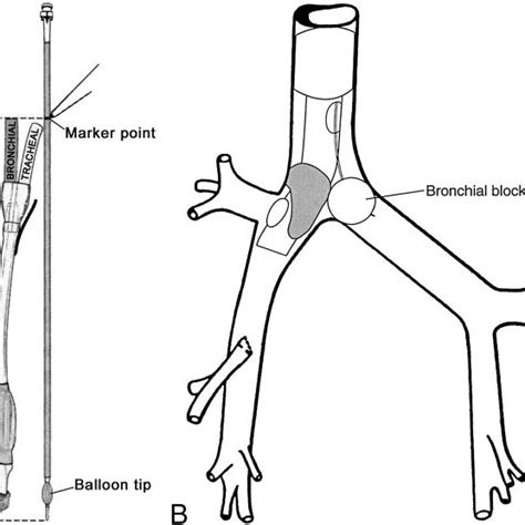 Pdf The Use Of A Bronchial Blocker To Rescue An Ill Fitting Double Lumen Endotracheal Tube