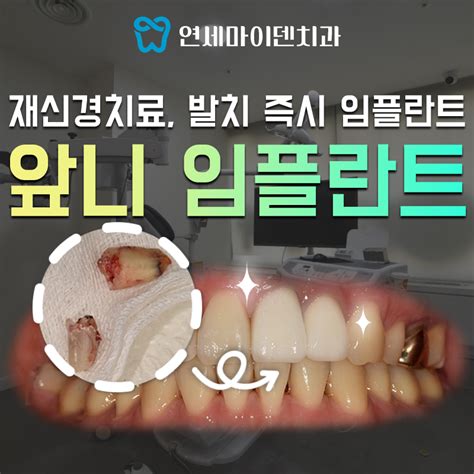 앞니 임플란트 후기 발치 즉시 임플란트와 재신경치료 광화문치과 연세마이덴치과🦷