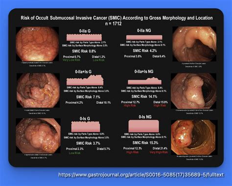 Klaus Mönkemüller On Linkedin Colon Polyp Morphology And Location Impact Risk Of Invasive Cancer